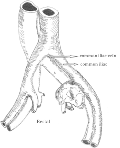 Complex Venous and Arterial Reconstruction with Deep Vein After Pelvic ...