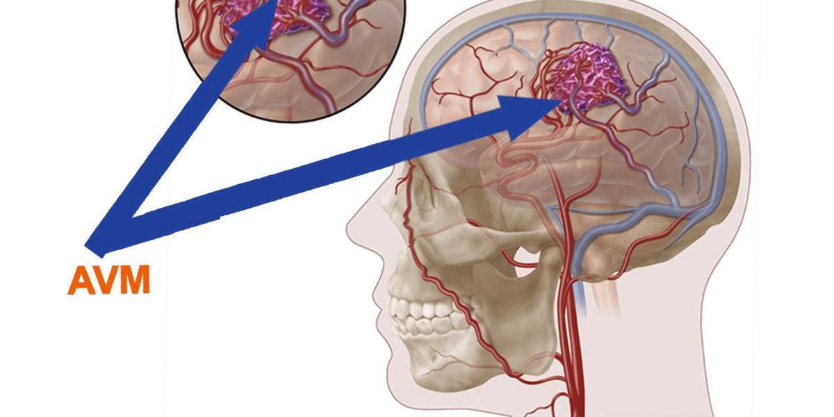What is an Arteriovenous Malformation? What are its Symptoms, Causes ...